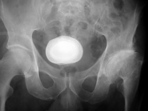 Bladder Stones: An Overview | Premier Hospital